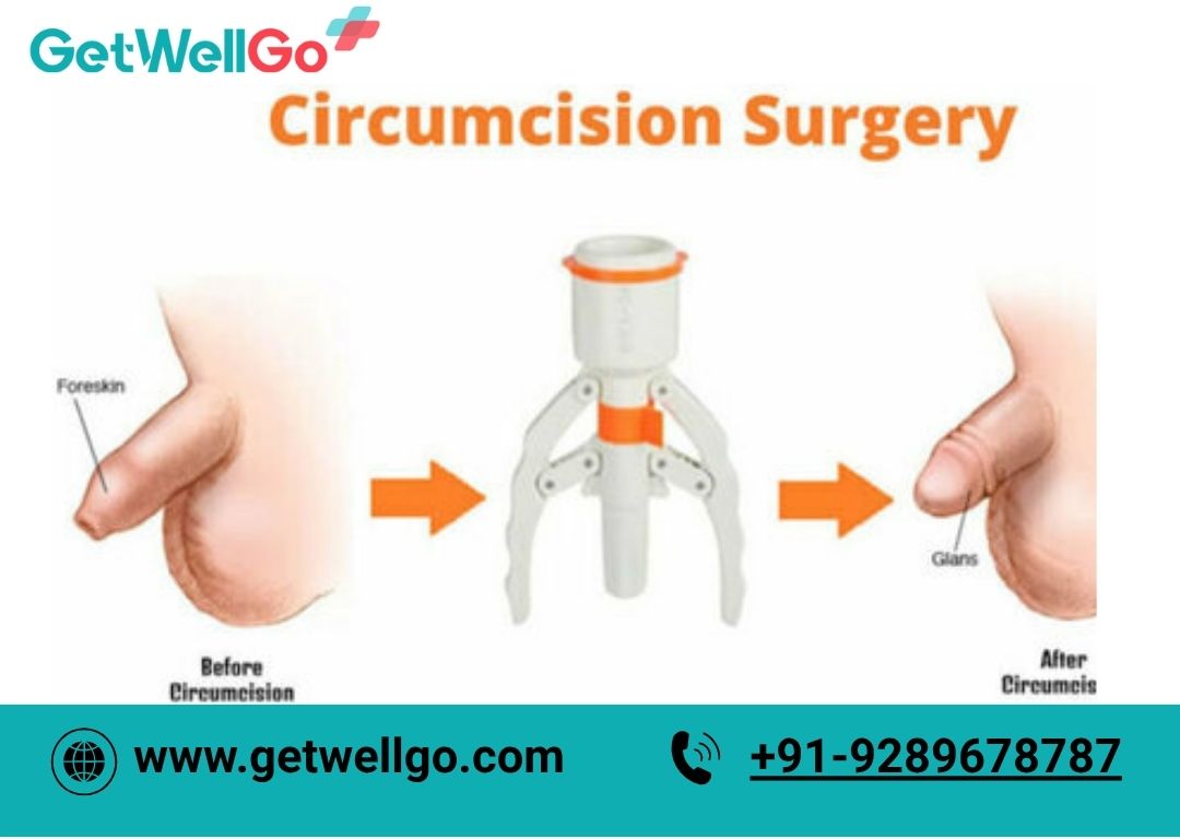 Circumcision: Procedure, Benefits & Recovery Guide